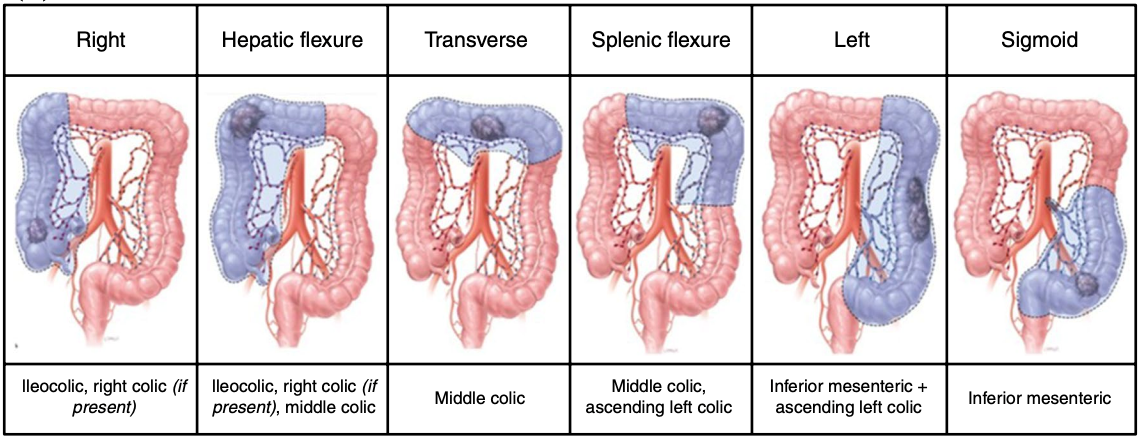 Standardization of Colon Resection for Cancer: An Overview of the American College of Surgeons ...